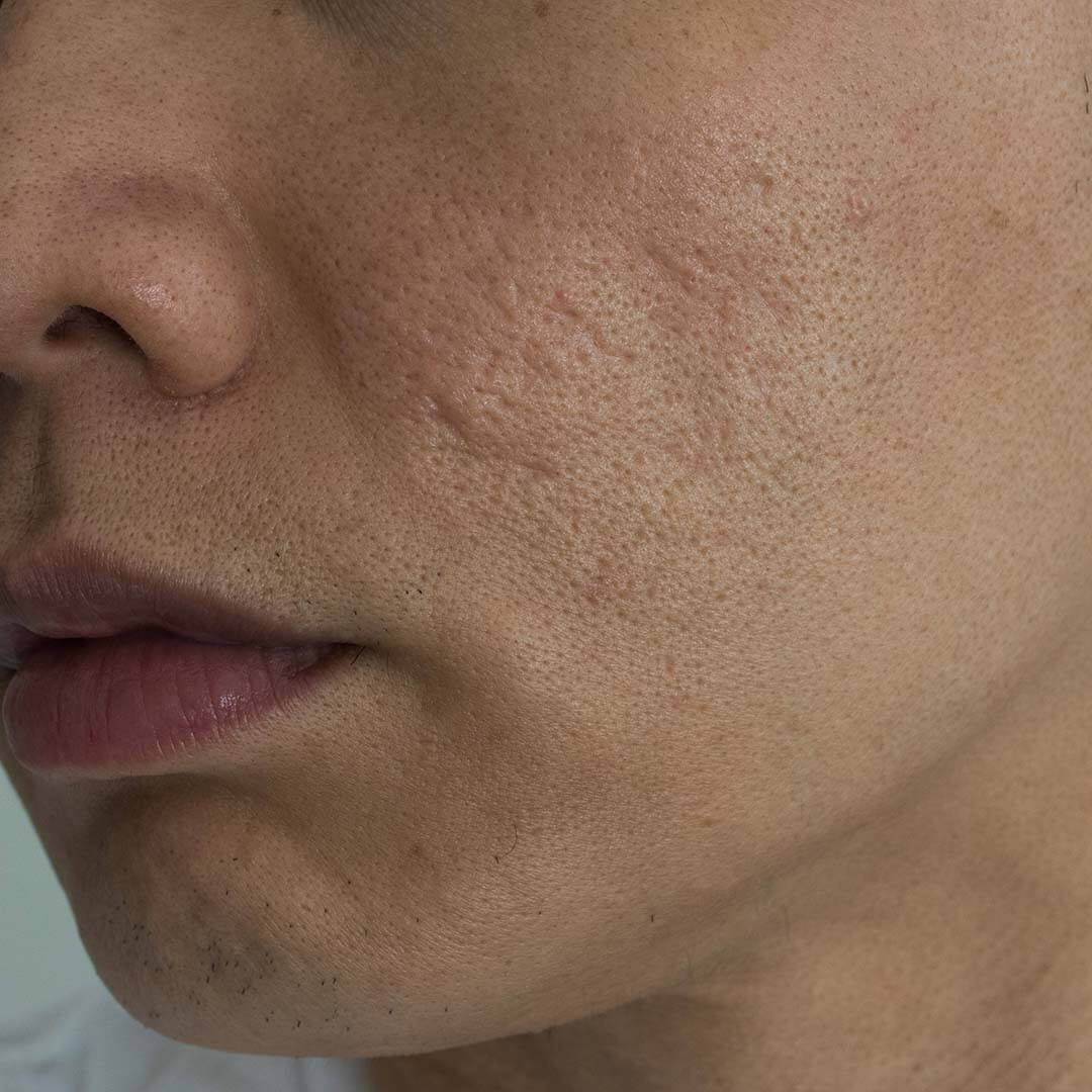 Acne - Kristal Skin & Laser Clinic