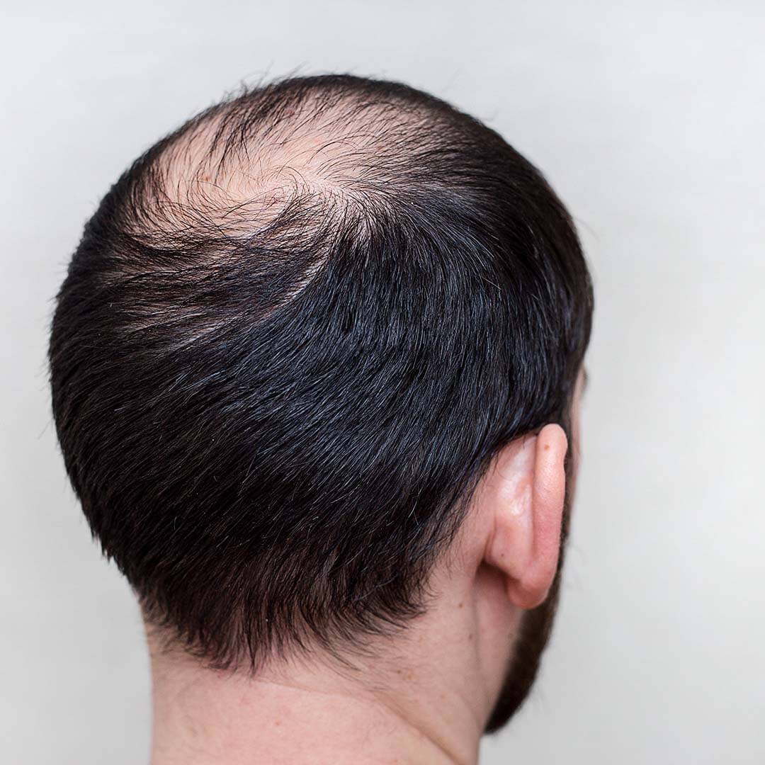 Alopecia - Kristal Skin & Laser Clinic