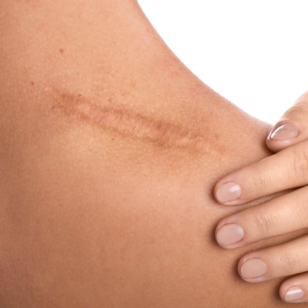 Operatie litteken - Kristal Skin & Laser Clinic